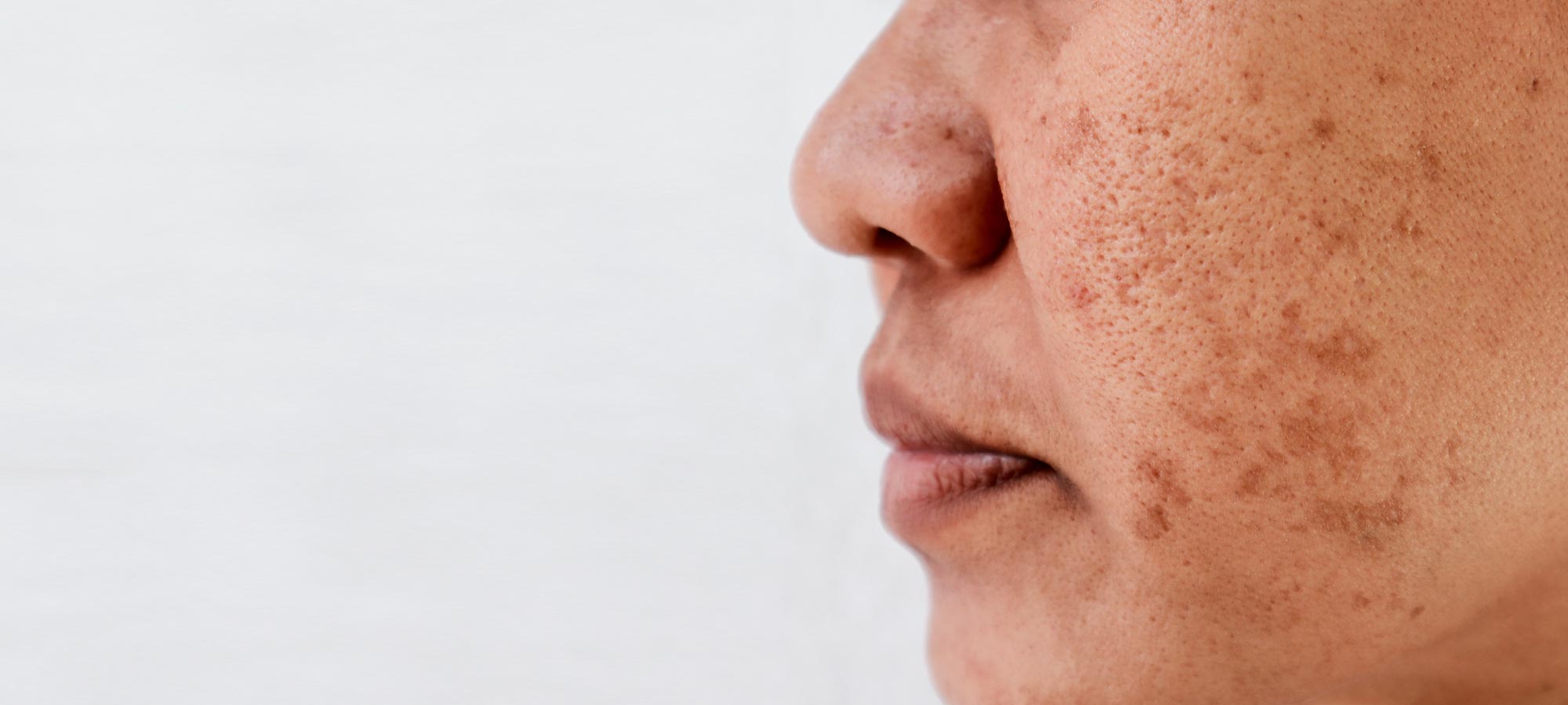 Avush - Dark Spot & Age Spot Remover without Hormones!